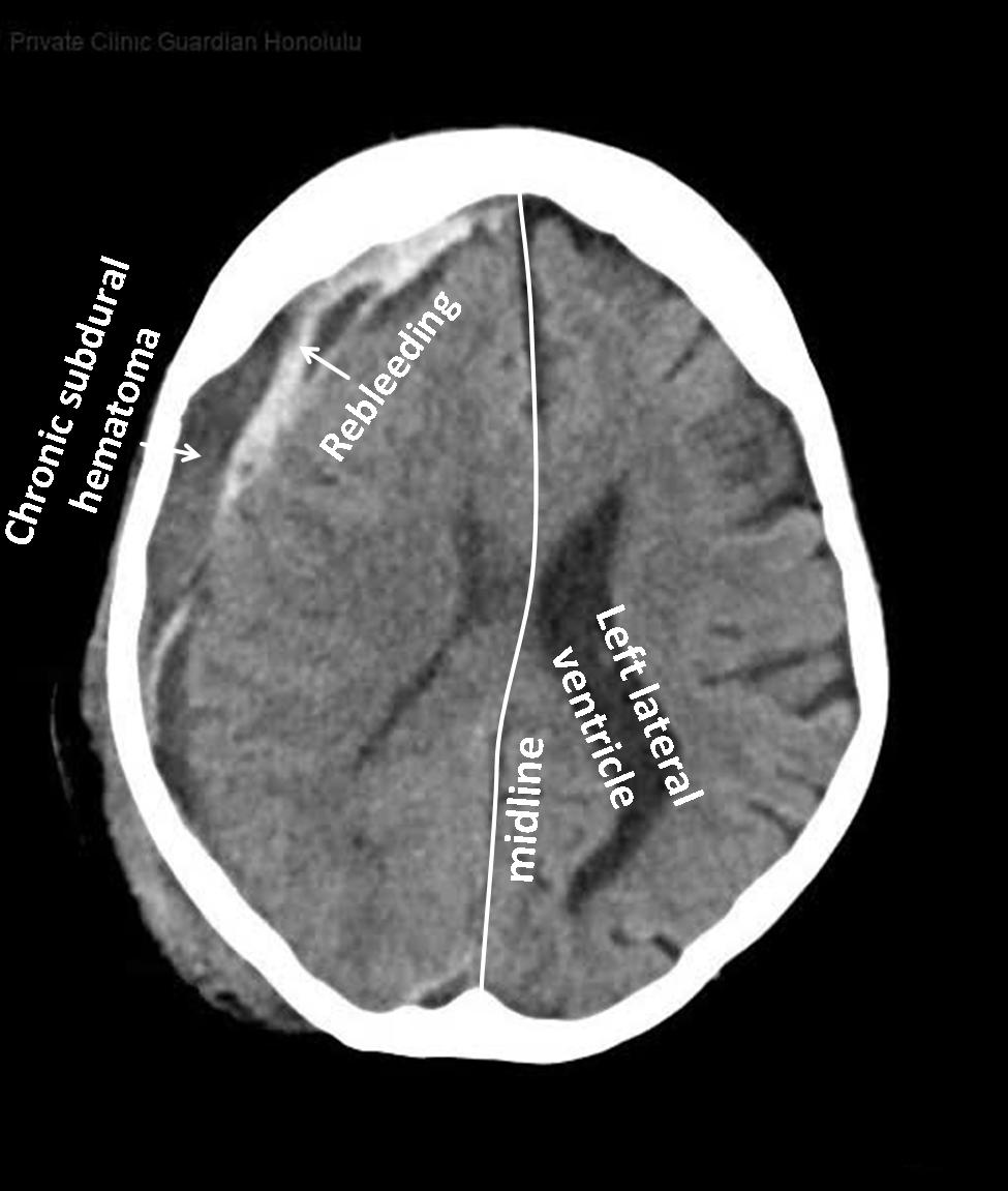 Chronic Subdural Hematoma